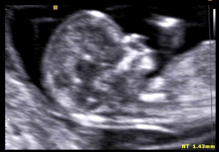 First trimester screening :: Remed13