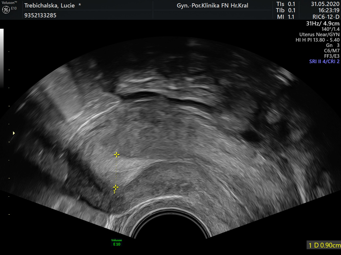 Co víte o endometrióze? :: Remed13
